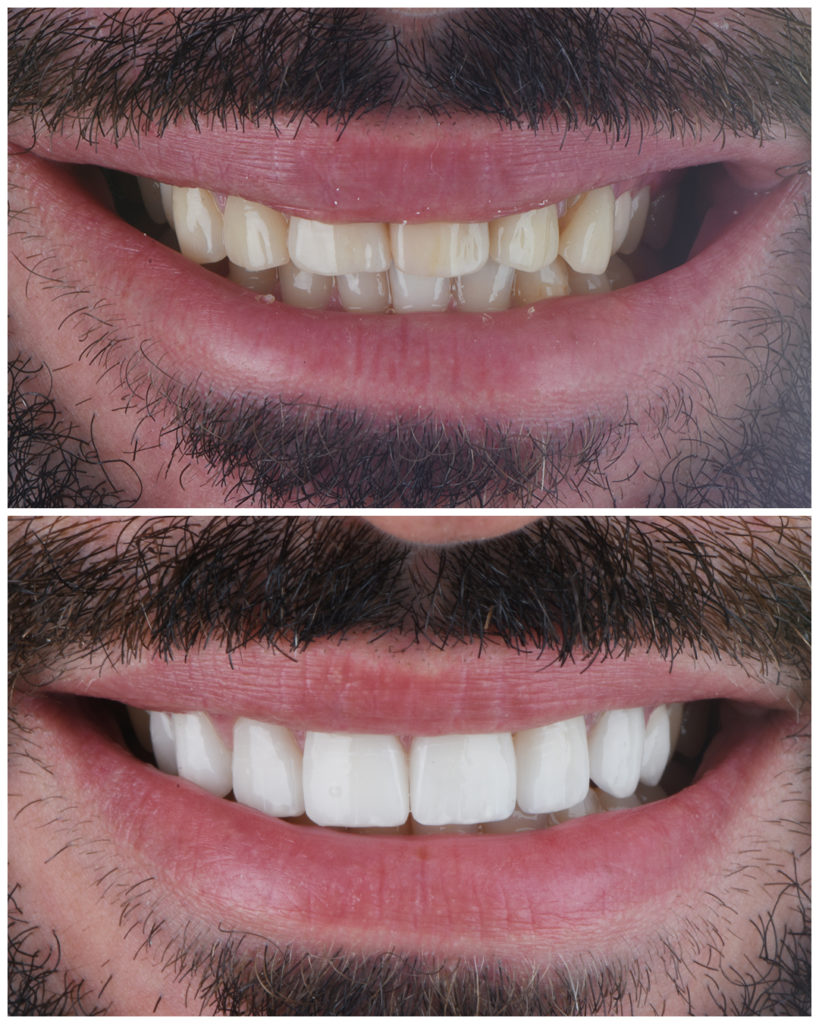 Before & After Gallery | Sharp Dentistry & Associates